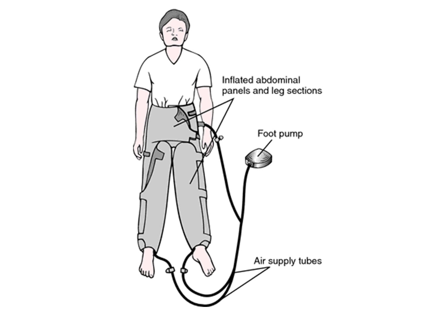 PASG Guide: Anti-Shock Pants Indications Safe Use